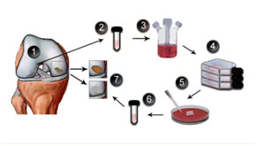 Matrix-Induced Autologous Chondrocyte Implantation Seattle | MACI ...