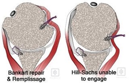 Remplissage Seattle, Bellevue | Infraspinatus Tenodesis Everett, Kirkland