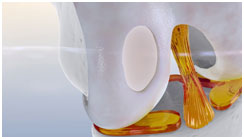 Matrix-Induced Autologous Chondrocyte Implantation Seattle | MACI ...