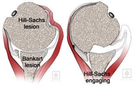 Remplissage Seattle, Bellevue | Infraspinatus Tenodesis Everett, Kirkland