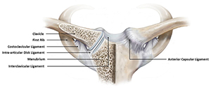 Sternoclavicular Joint Injury Seattle, WA | Shoulder Instability ...