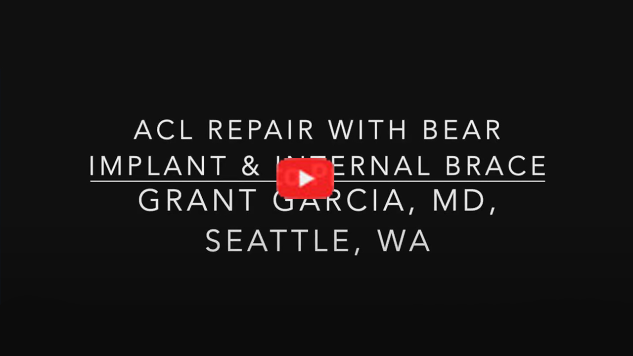 BEAR Implant (ACL Restoration Surgery) Seattle, WA | Pediatric ACL ...
